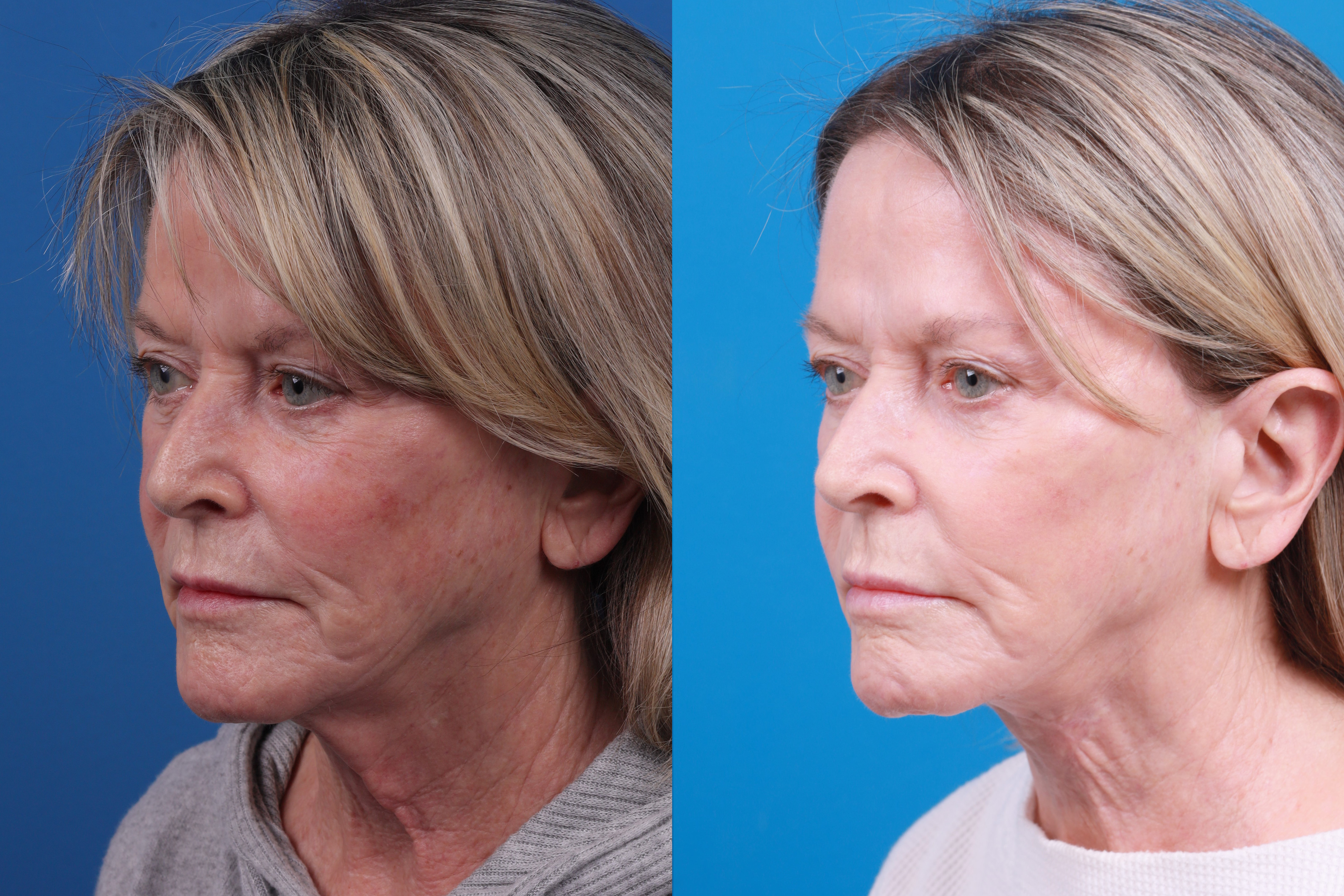 Patient 146900704 | Profile Neck Lift Before & After Photos | Clevens ...