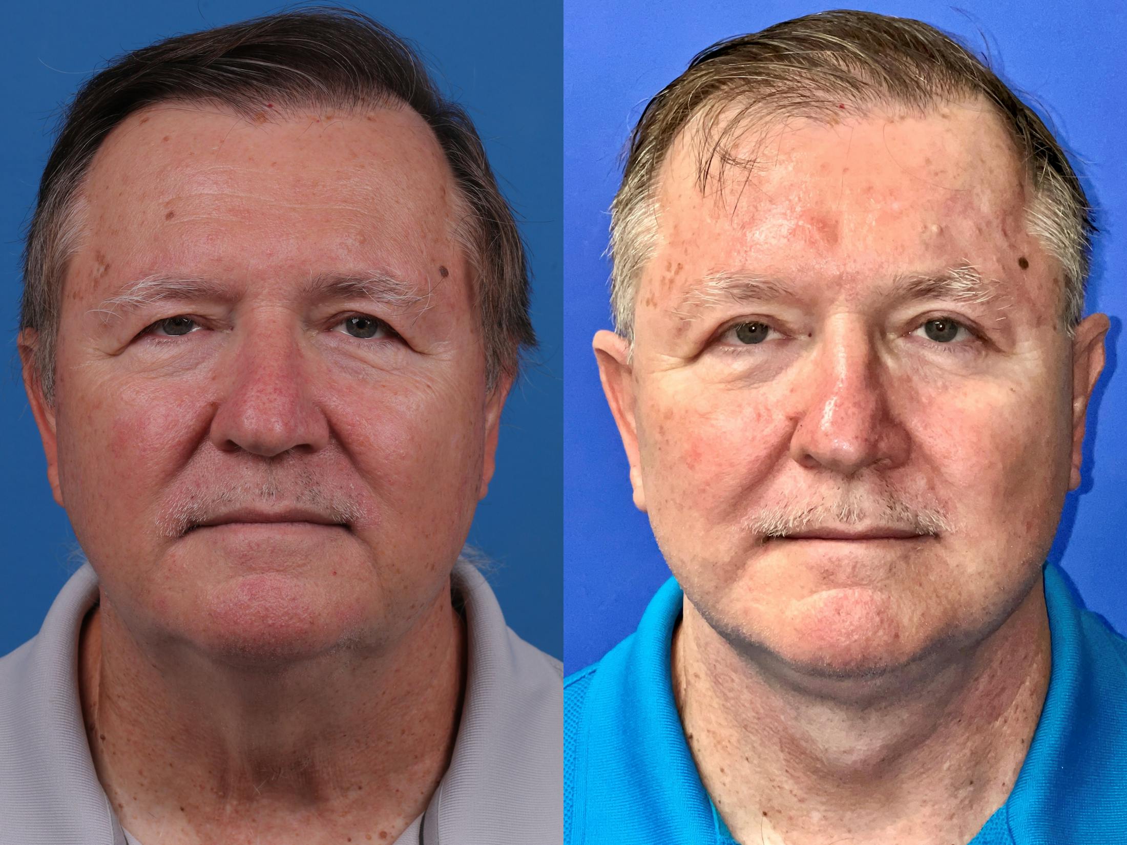 Patient 148036528 | Male Eyelid Surgery Before & After Photos | Clevens ...