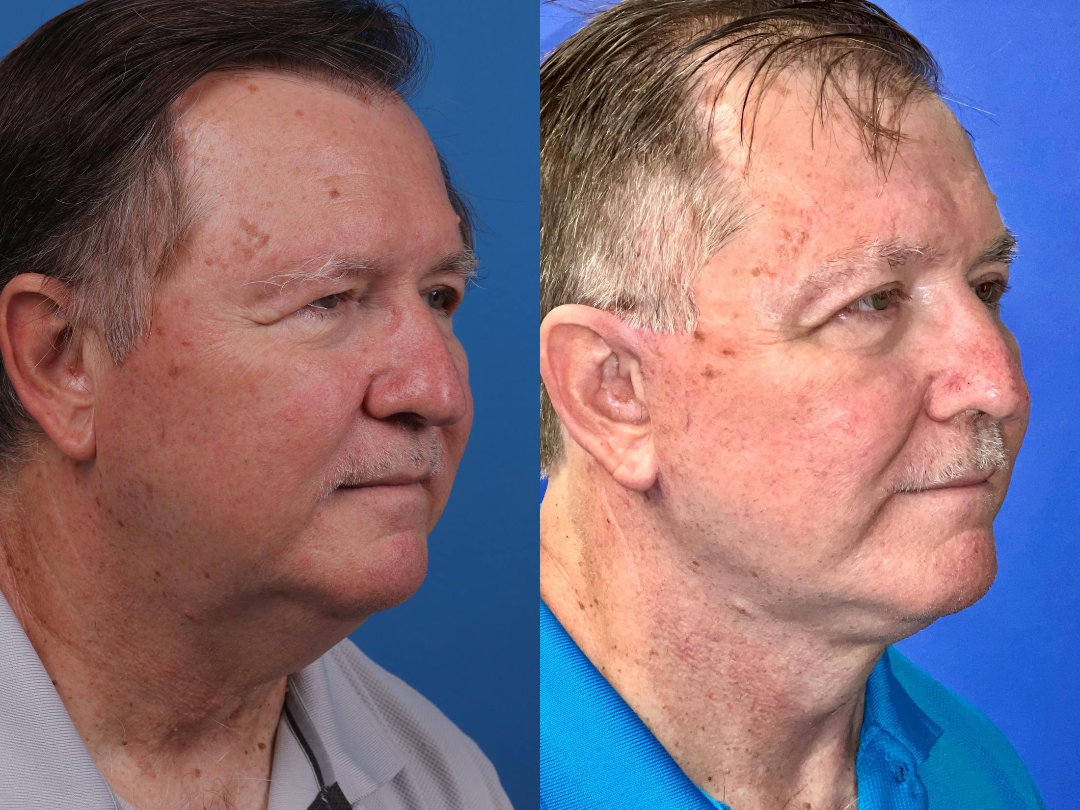 Patient 148036527 | Male Facelift Before & After Photos | Clevens Face ...