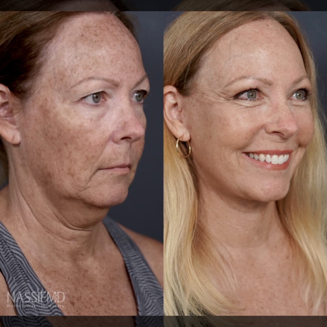 BBL (Broadband Light) Before & After Photos | NassifMD® Medical Spa