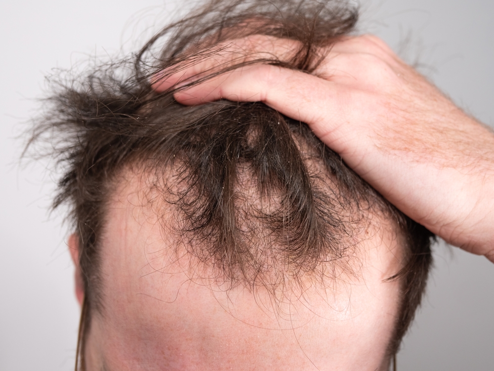 Receding Hairline Stages Signs Treatment What Is An M Shaped Hairline?