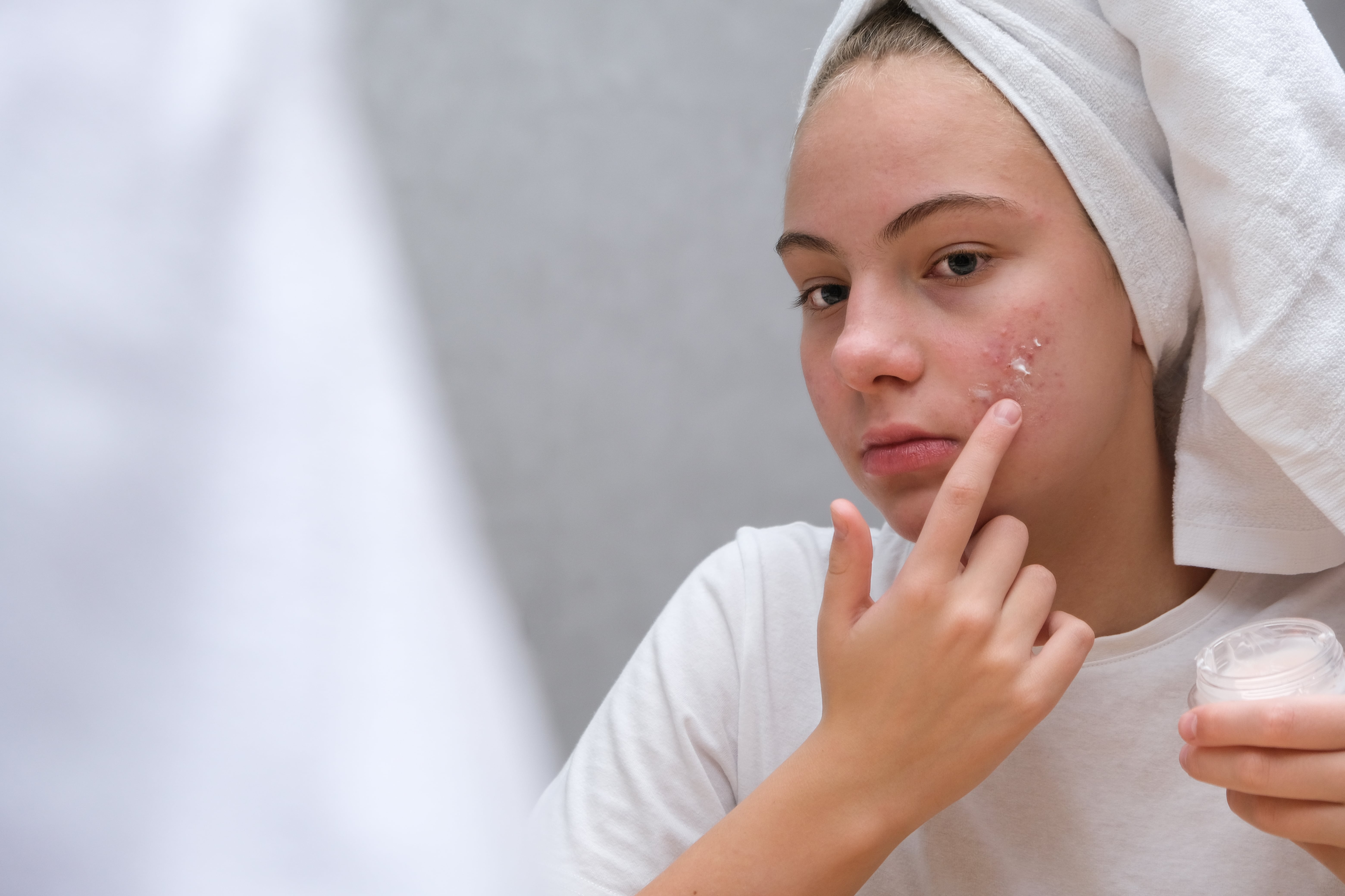 Acne Treatments Comparison: Tretinoin, Treclin Gel & Ketrel