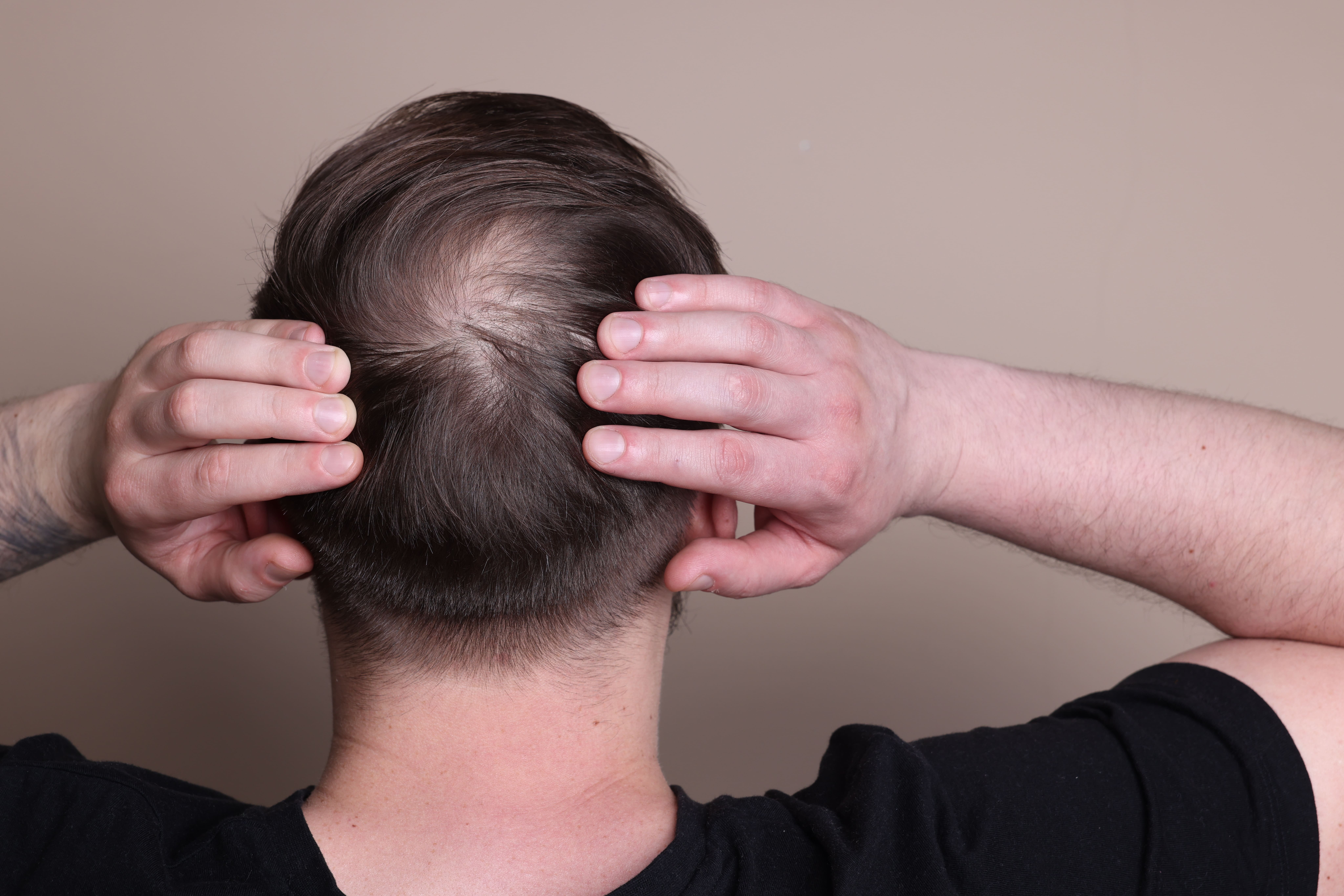 Früher Haarausfall: Ursachen & Lösungen für junge Männer