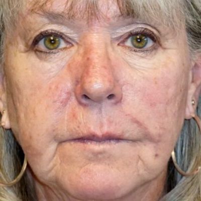 Facial Reconstruction Before & After Photos | Refine Facial Plastic ...