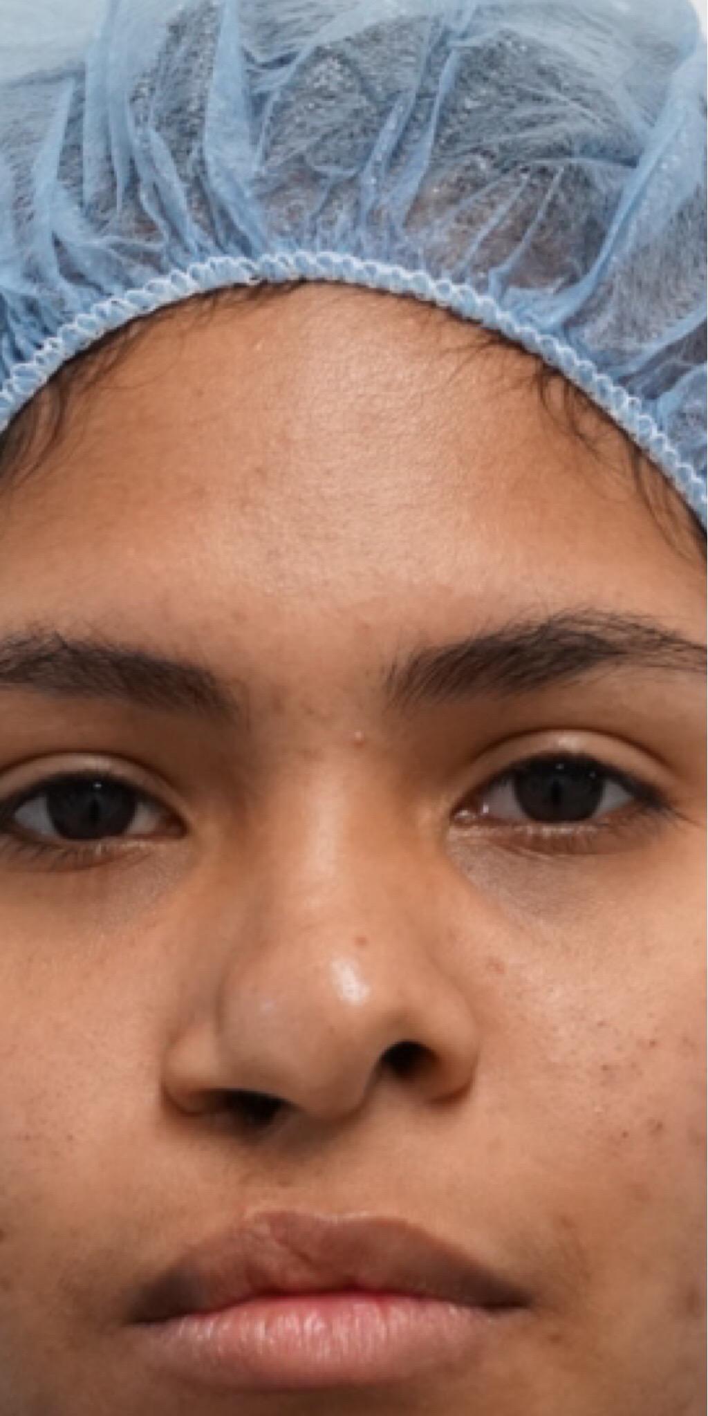 Facial Reconstruction Before & After Photos | Refine Facial Plastic ...