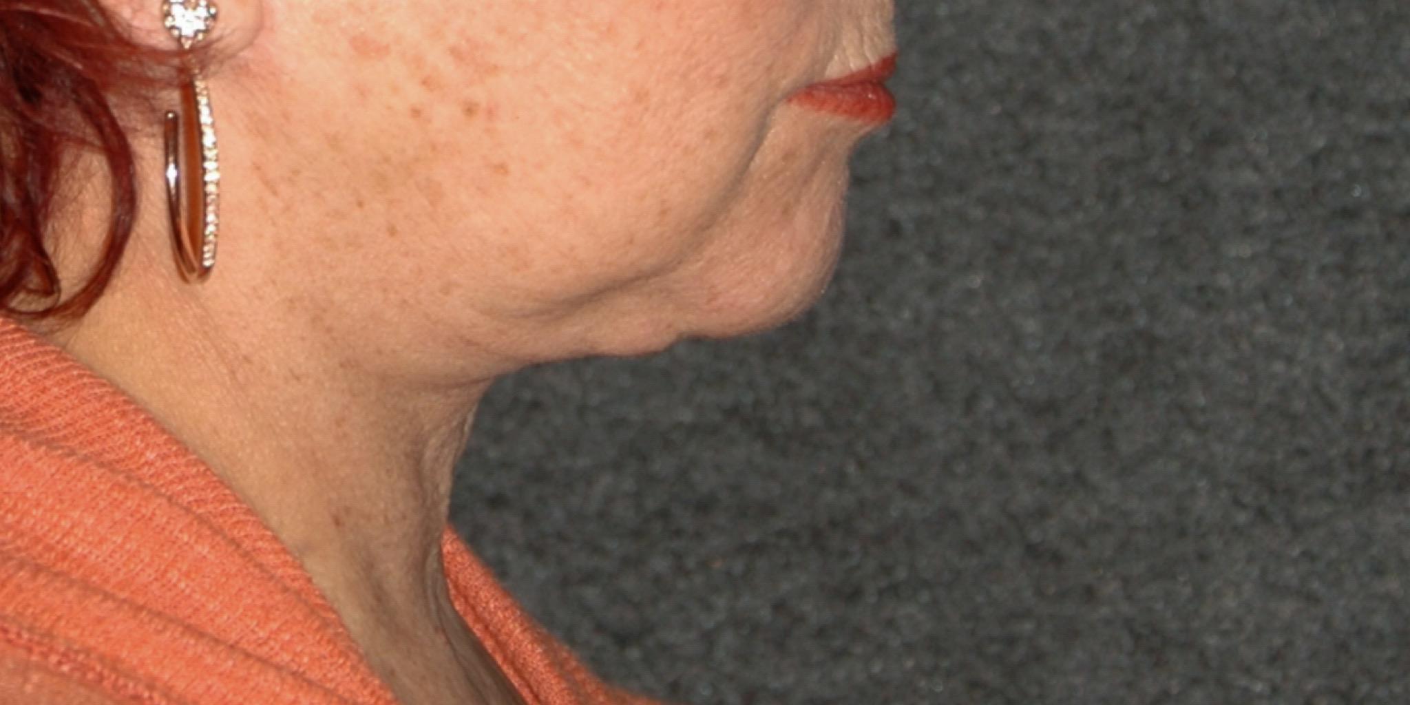 Patient 5922988 | Deep Neck Lift Before & After Photos | Refine Facial ...