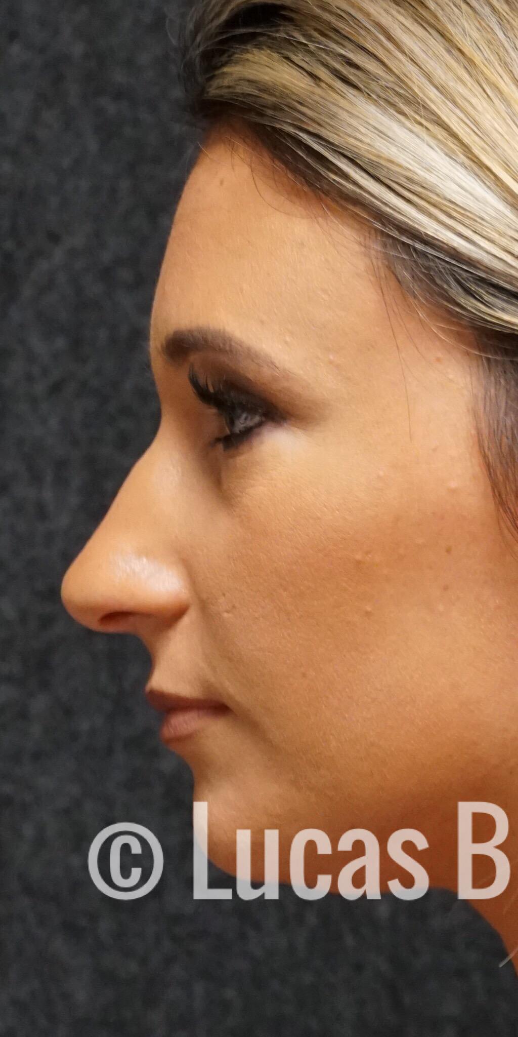 Liquid Rhinoplasty Before & After Photos | Refine Facial Plastic ...