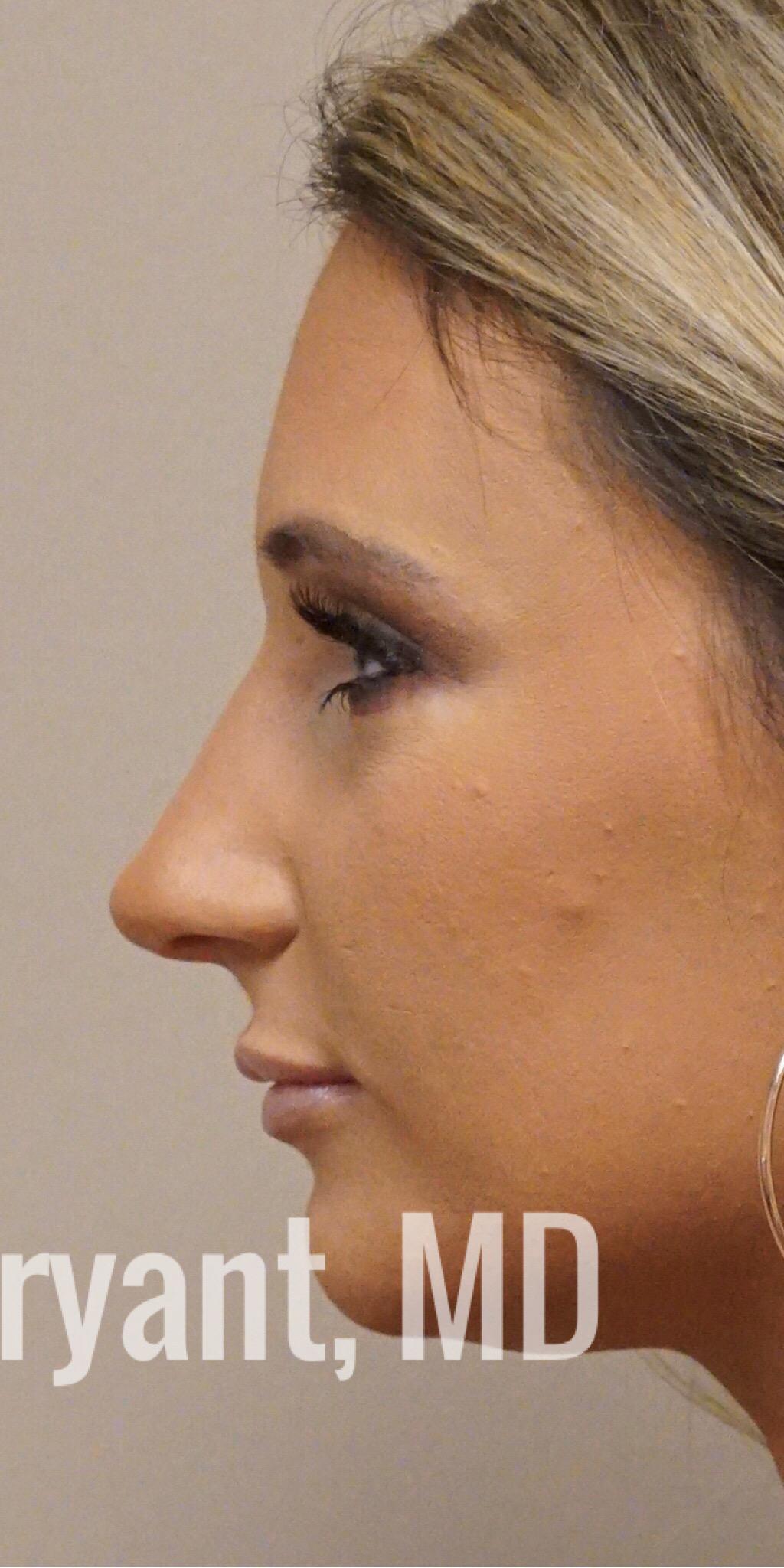 Liquid Rhinoplasty Before & After Photos | Refine Facial Plastic ...