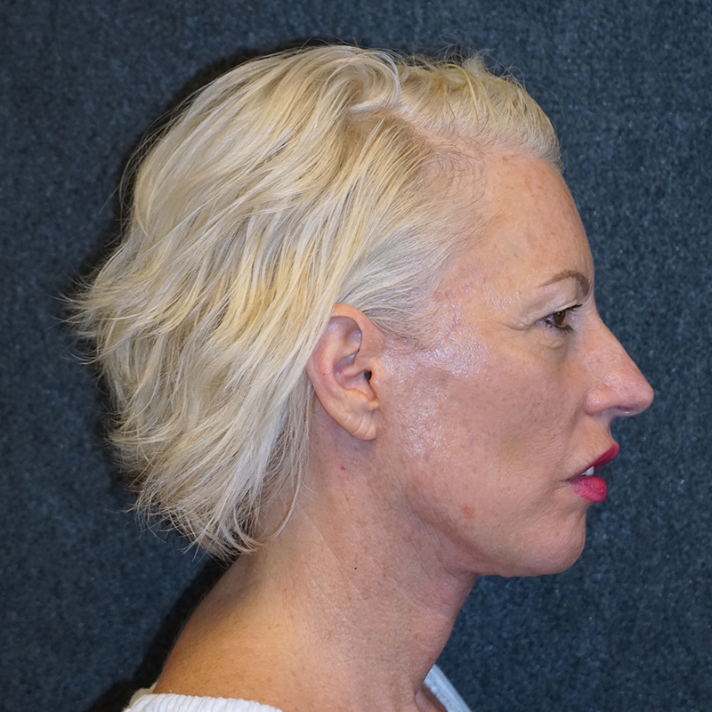 Patient 55432358 | Deep Plane Facelift Before & After Photos | Refine ...