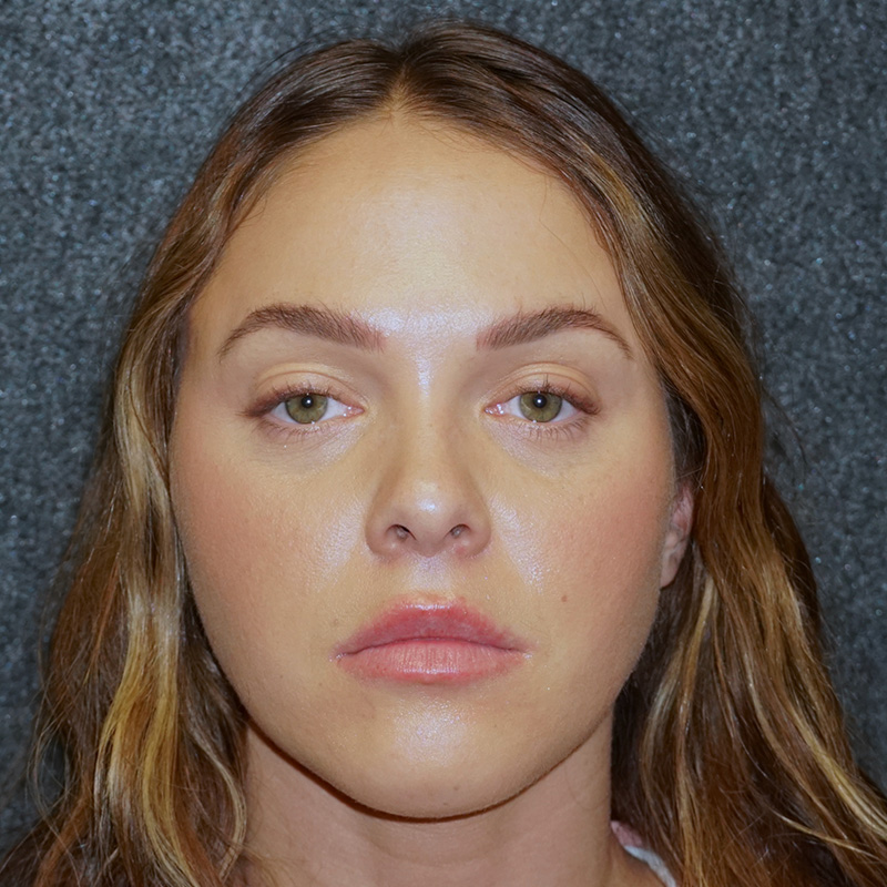Patient 56010236 Lip Lift Before And After Photos Refine Facial Plastic Surgery And Aesthetics