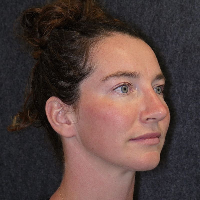 Revision Rhinoplasty Before & After Photos | Refine Facial Plastic ...