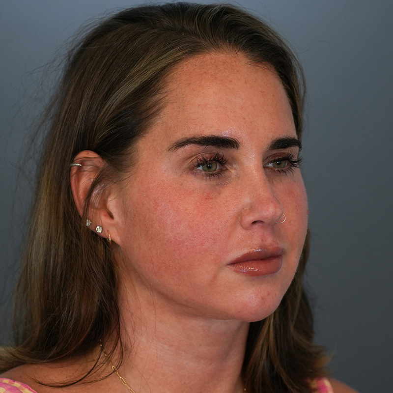 Deep Neck Lift Before & After Photos | Refine Facial Plastic Surgery ...