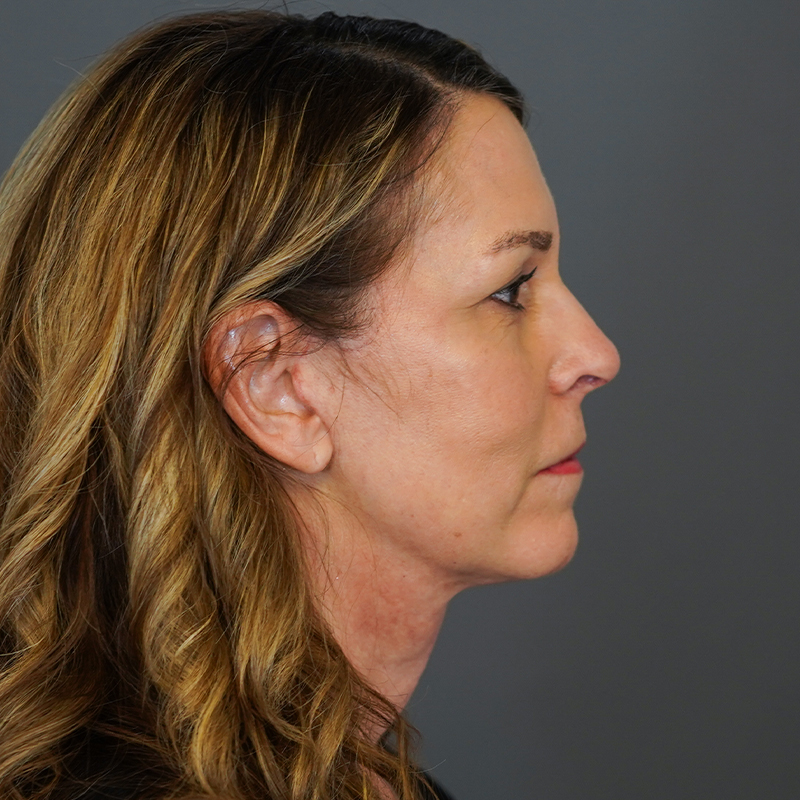 Deep Neck Lift Before & After Photos | Refine Facial Plastic Surgery ...
