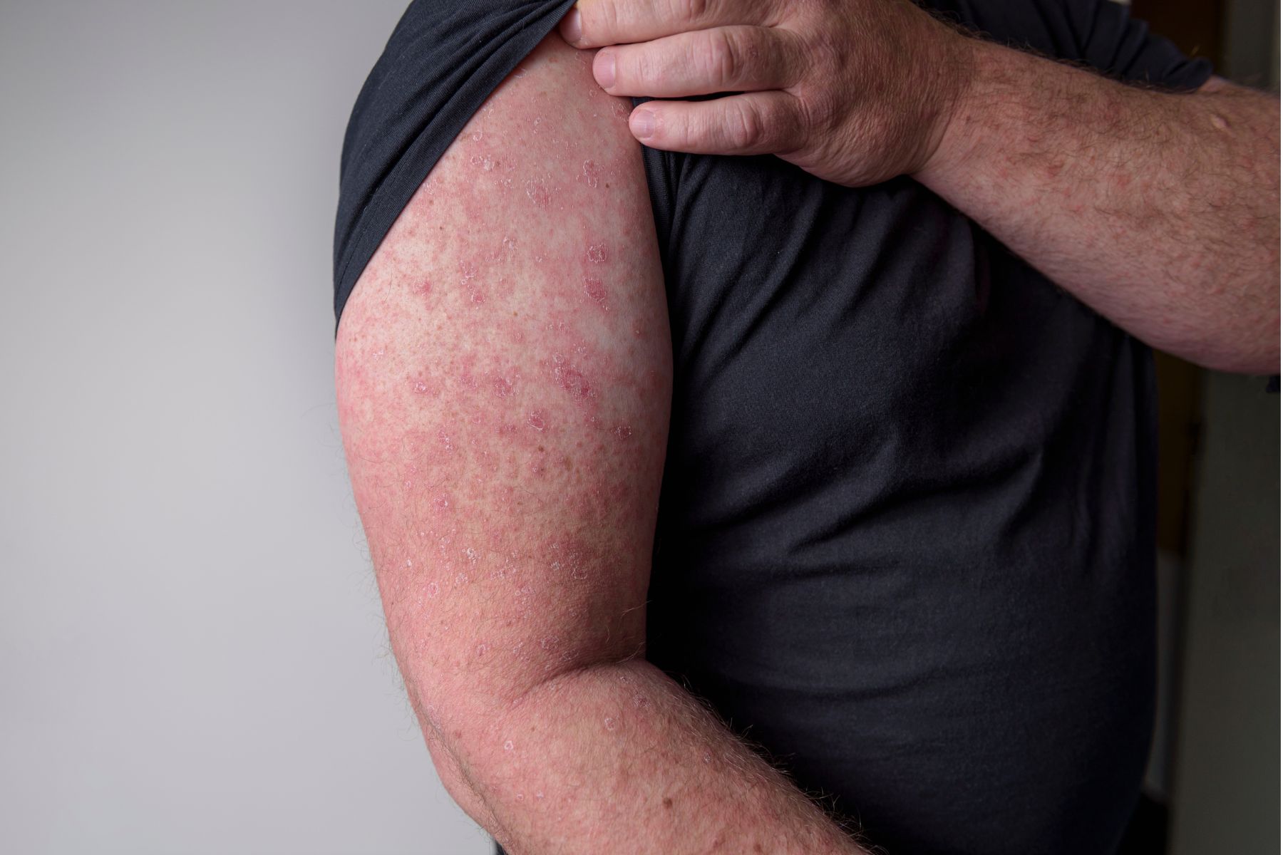 Wondroos: symptomen en behandeling - Doktr