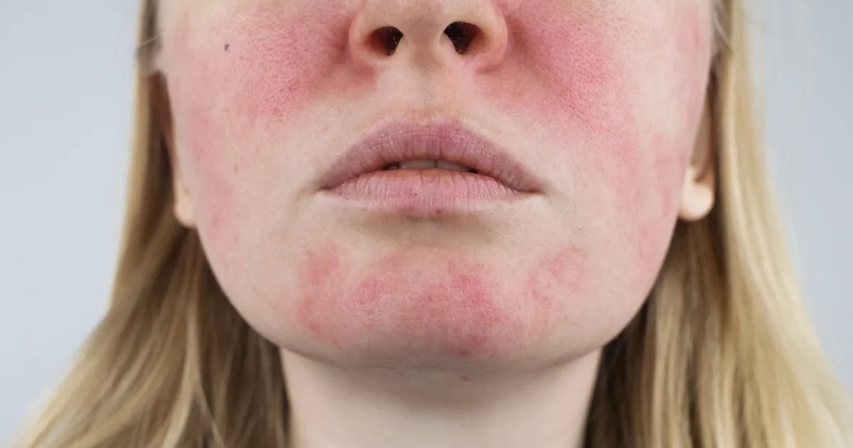 Rosacée : cause et traitement - Doktr