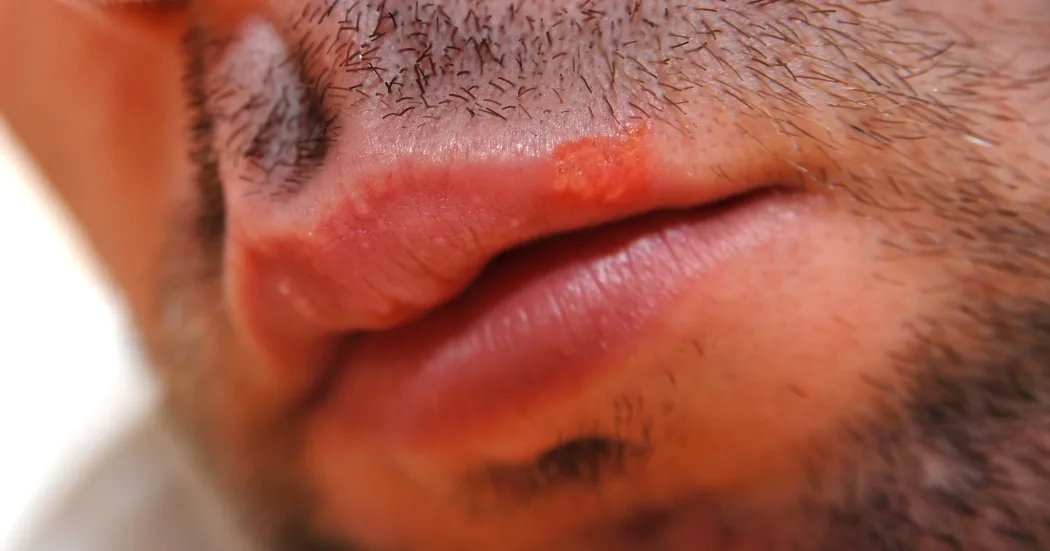 Bouton de fièvre : causes et traitements - Doktr