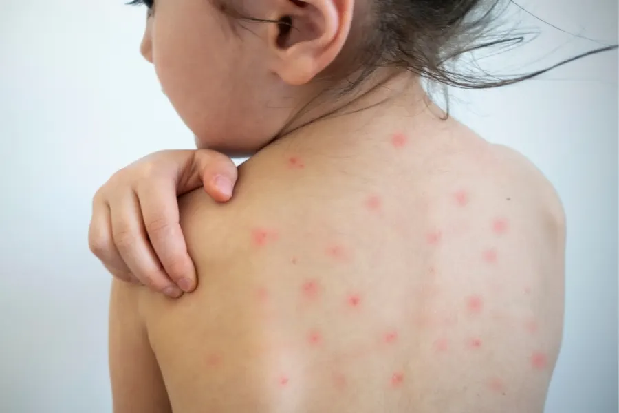 Windpokken (waterpokken): symptomen en behandeling - Doktr