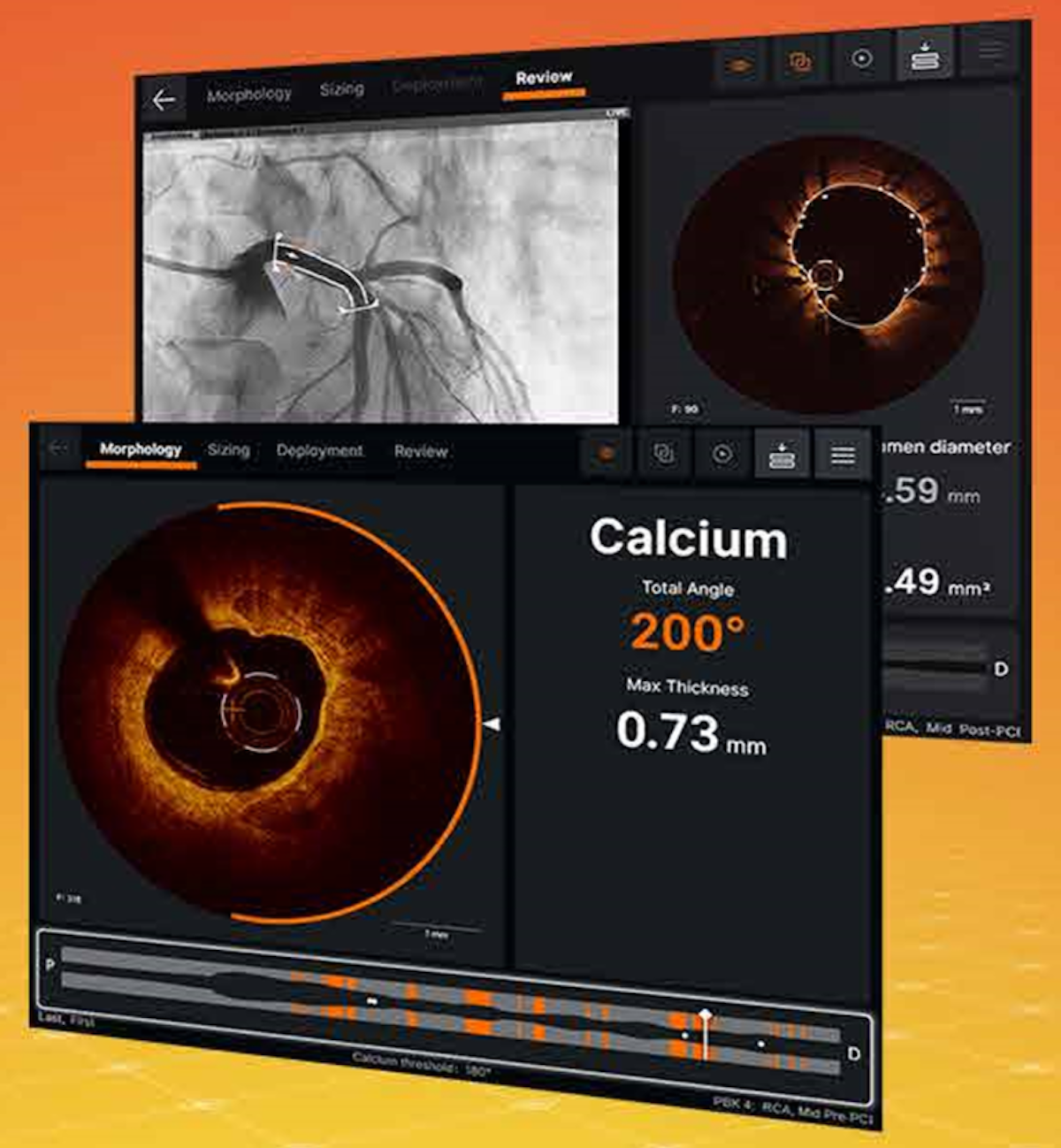 Procédure OCT avec OPTIS