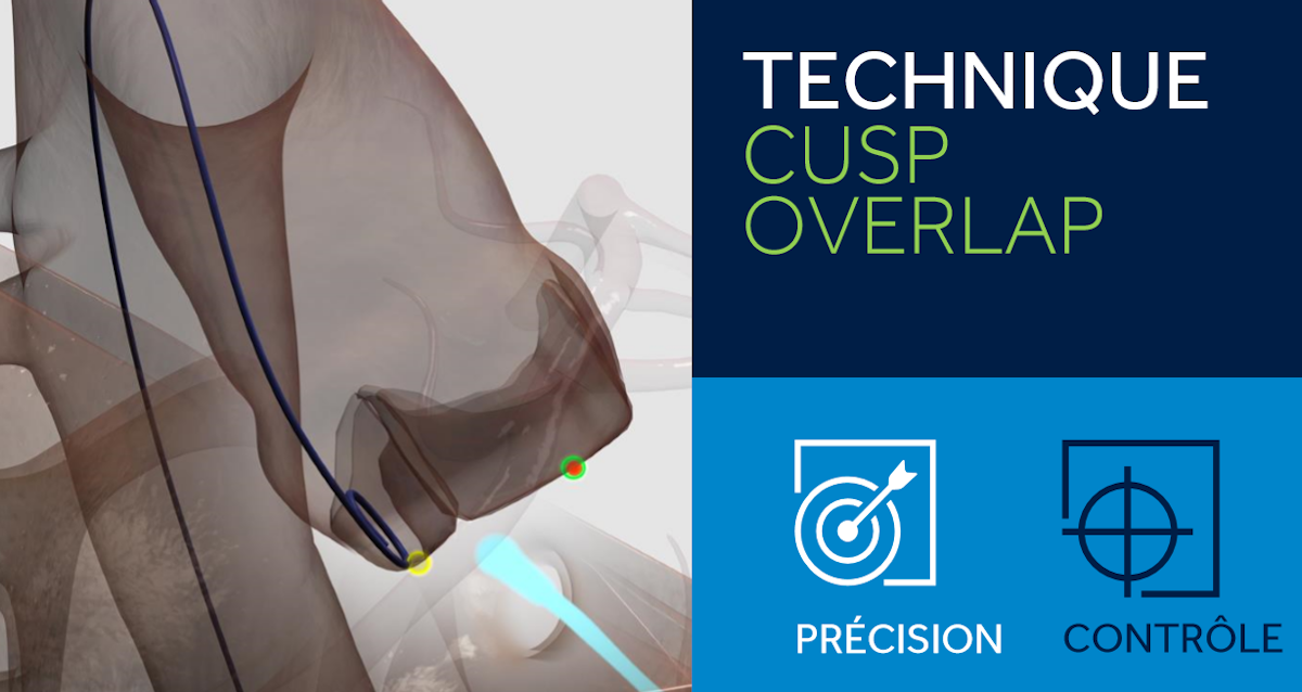 Technique cusp overlap Technique cusp overlap