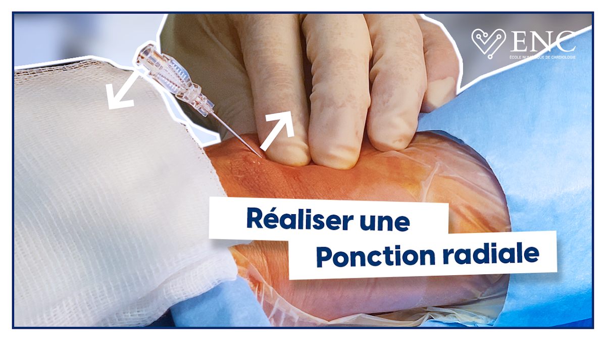 Comment réaliser une ponction radiale