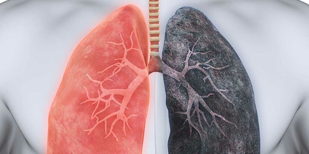 Smoking Before Bariatric Surgery… Can I Obesity Control Center