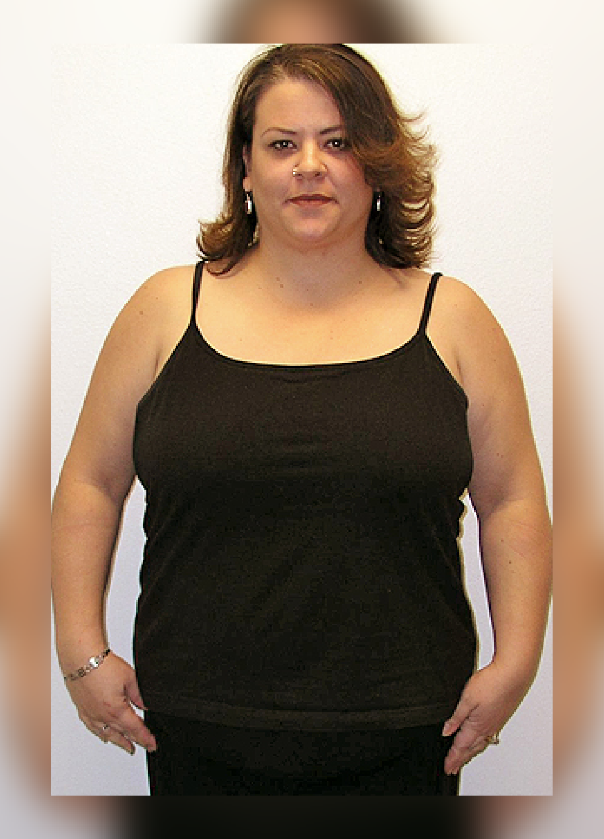 Patients 40-59 Years Old Before & After Photos | Page 4 | Obesity ...