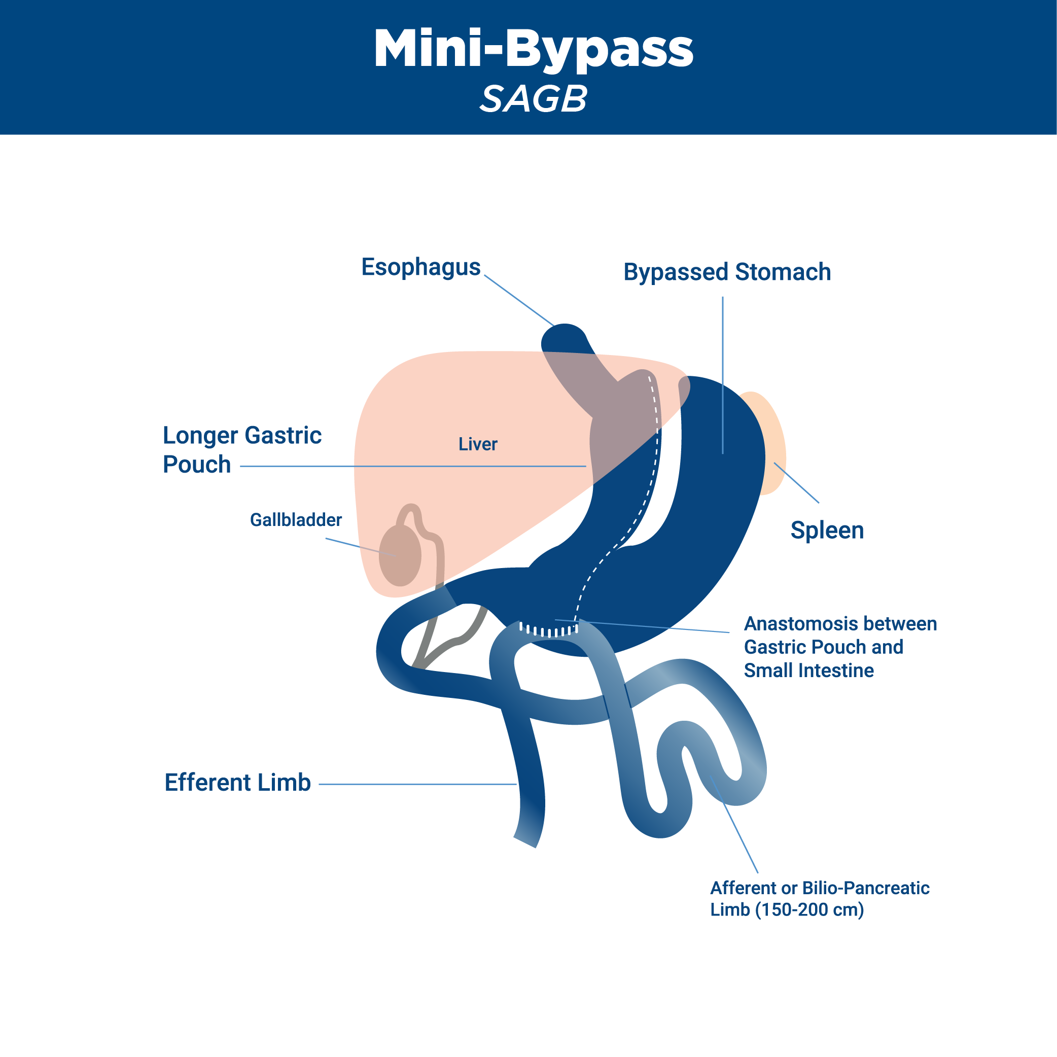 Mini Gastric Bypass Tijuana | Mini Gastric Bypass Mexico
