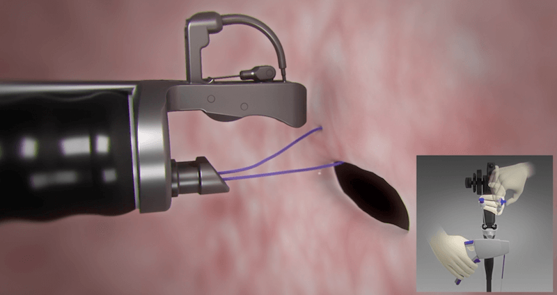 Endoscopic Sleeve Tijuana | Endoscopic Sleeve Mexico