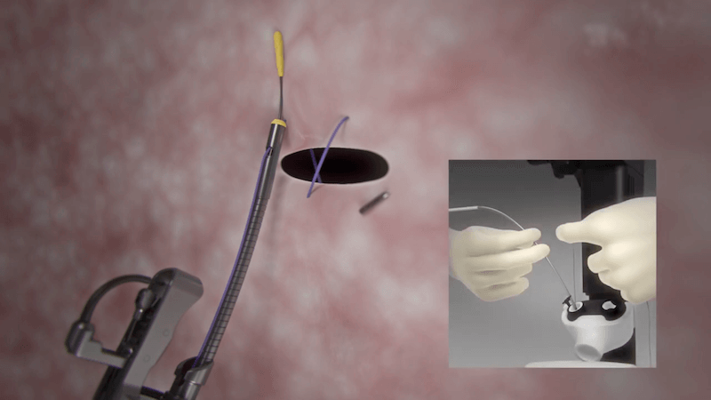 Endoscopic Sleeve Tijuana | Endoscopic Sleeve Mexico