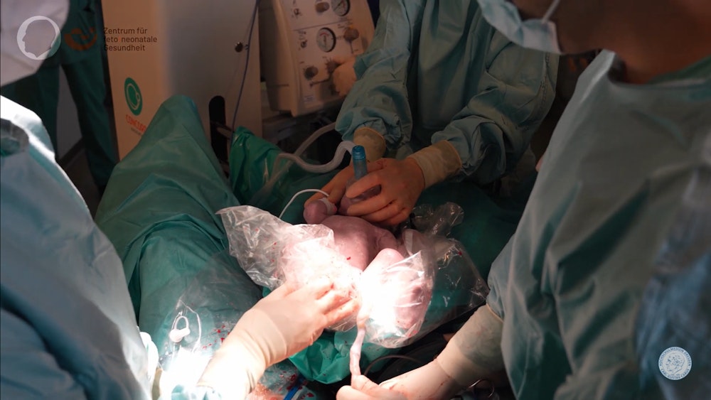 Cord Clamping | Concord Neonatal