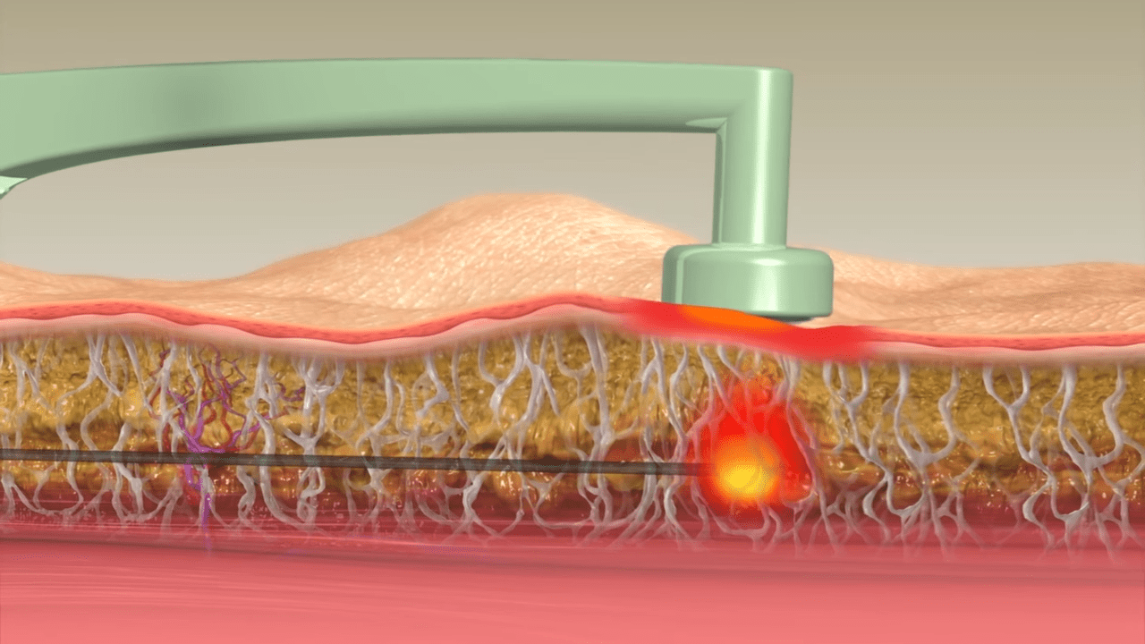 BodyTite – Weight Loss Surgery Center in Northwest Arkansas | Roller ...