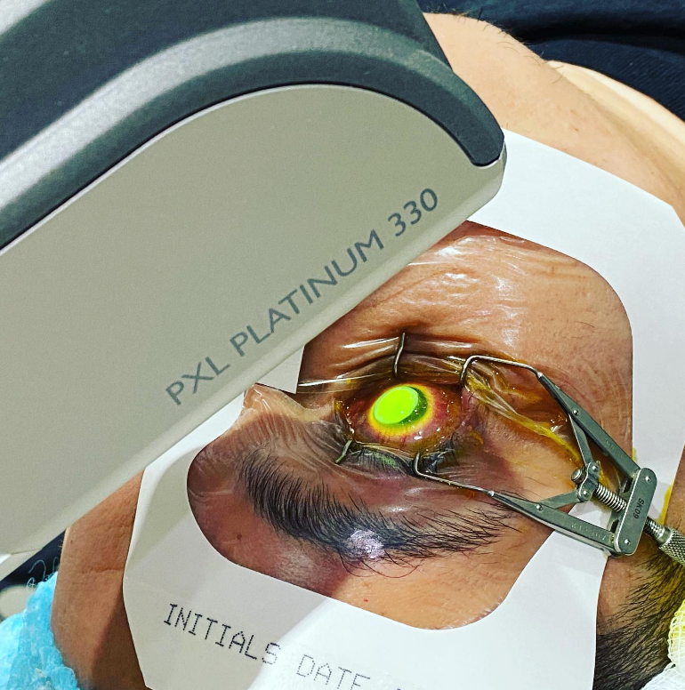 Collagen Crosslinking | Soroudi Advanced LASIK & Eye Centers