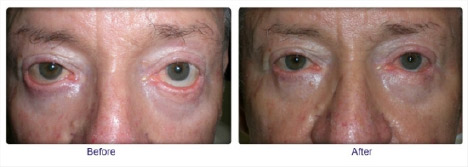 Everted Eyelid (Ectropion) Repair Los Angeles | Everted Eyelid Repair ...