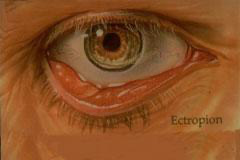 Everted Eyelid (Ectropion) Repair Los Angeles | Everted Eyelid Repair ...