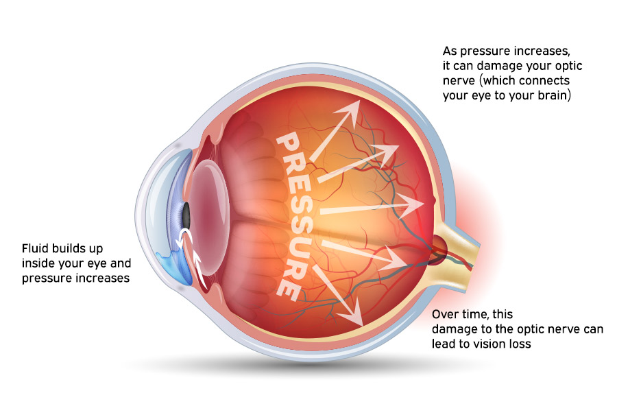 Implantable Durysta Los Angeles | Implantable Durysta Beverly Hills