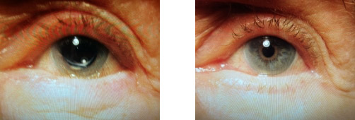 Invtered Eyelid (Entropion) Repair Los Angeles | Inverted Eyelid Repair ...