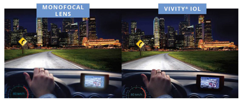 Vivity Lens Los Angeles | Vivity Lens Glendale, Beverly Hills, Newport ...