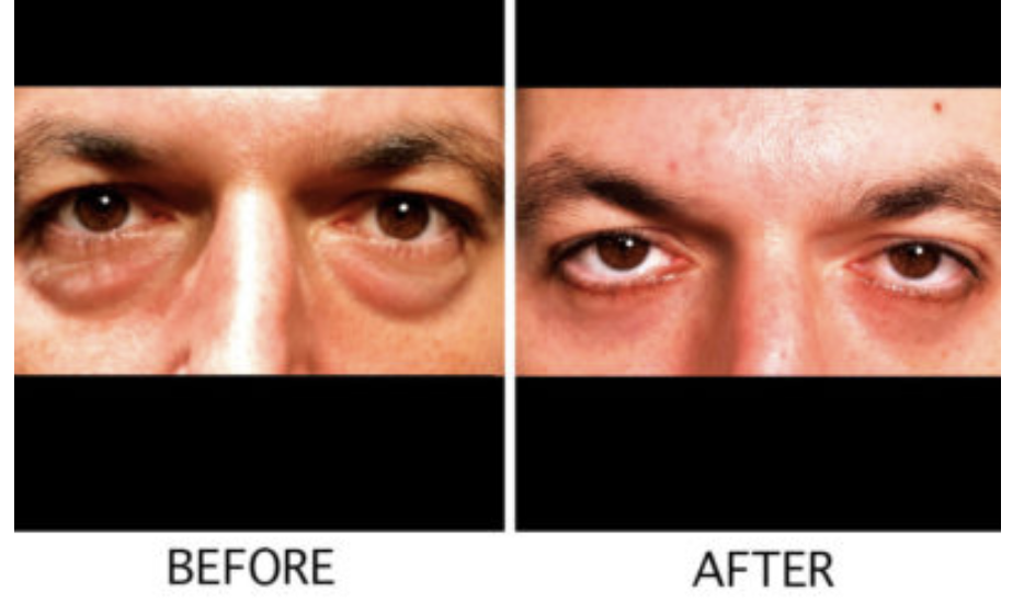 Before & After Photos | Soroudi Vision