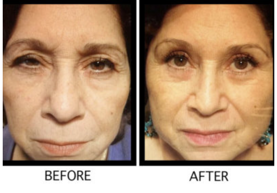 Blepharoplasty (Eyelid Surgery) Before & After Photos | Soroudi Vision
