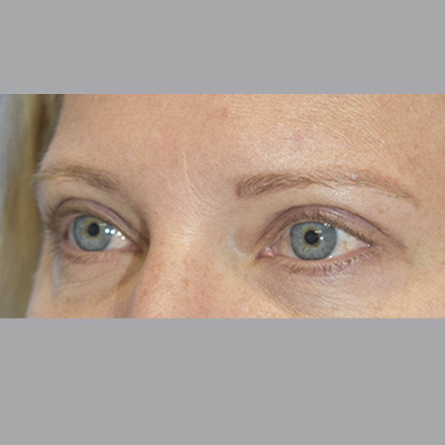 Blepharoplasty Before & After Photos | Markelov MD