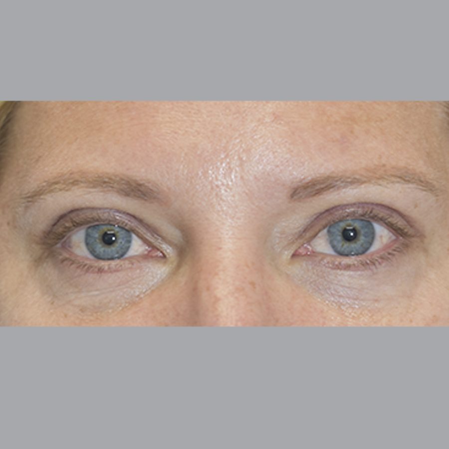 Blepharoplasty Before & After Photos | Markelov MD