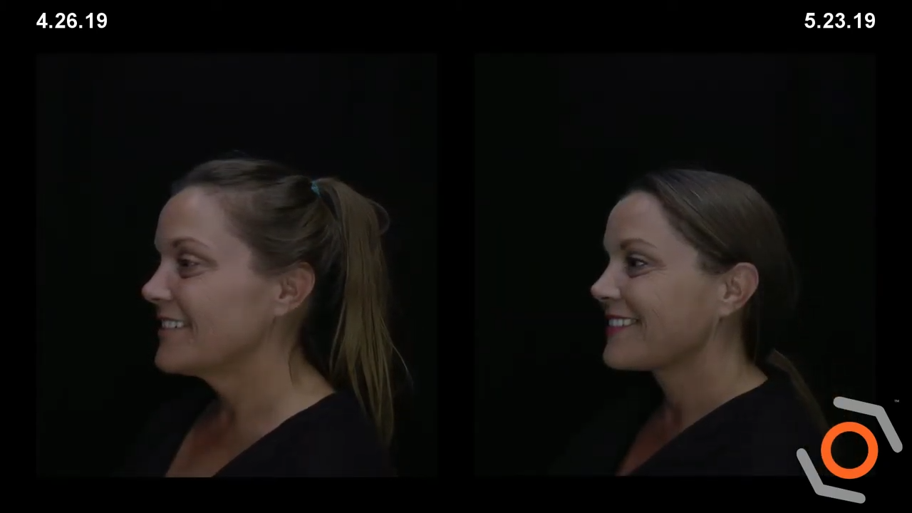 MyEllevate | Virginia Institute of Plastic Surgery