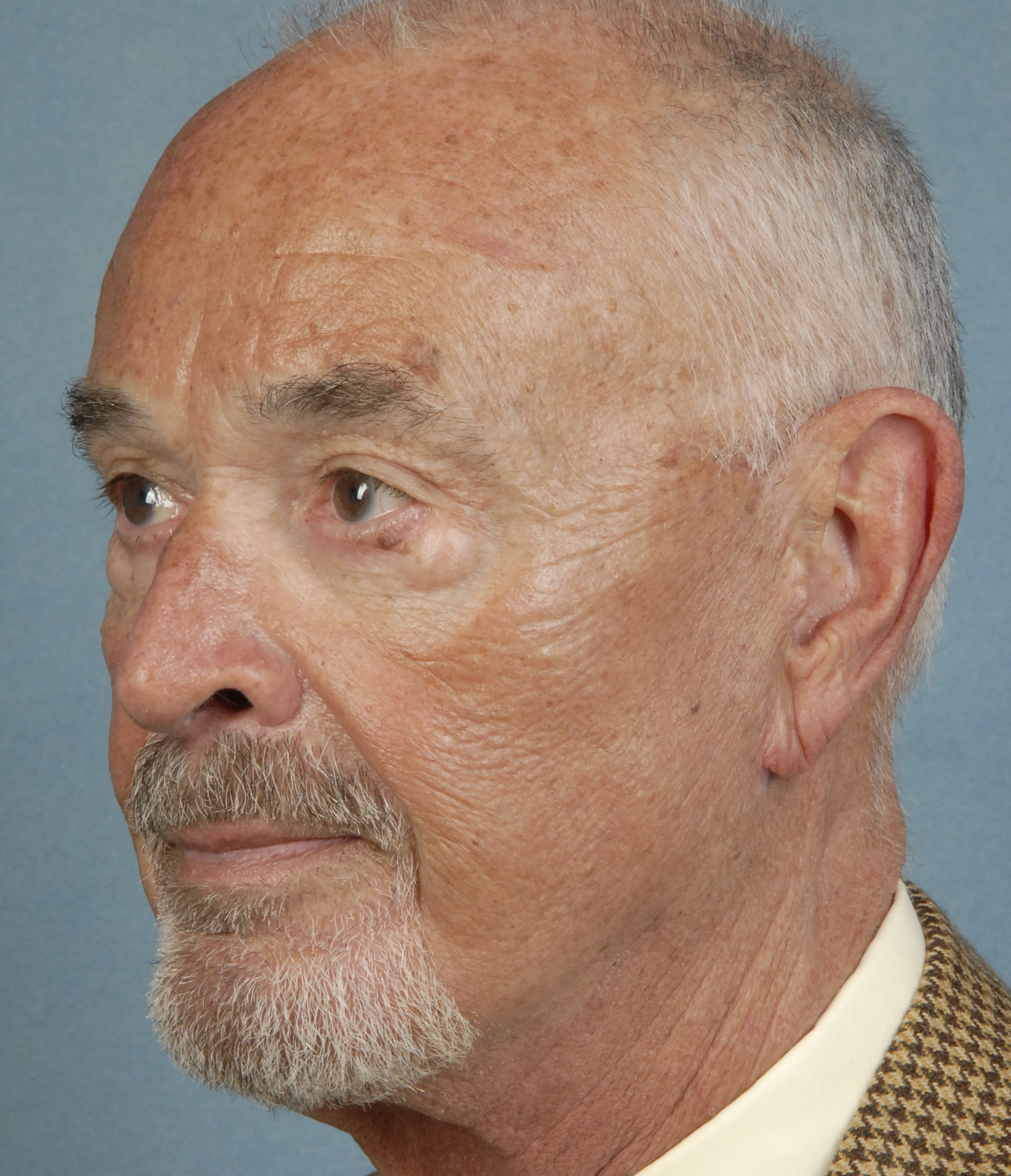 Patient 67109779 | Facelift Before & After Photos | Dr. Lawrence Bass