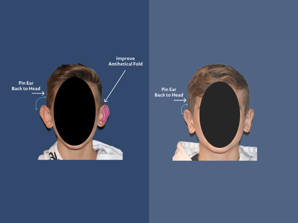 Ear Surgery in San Antonio | Hill Country Plastic Surgery