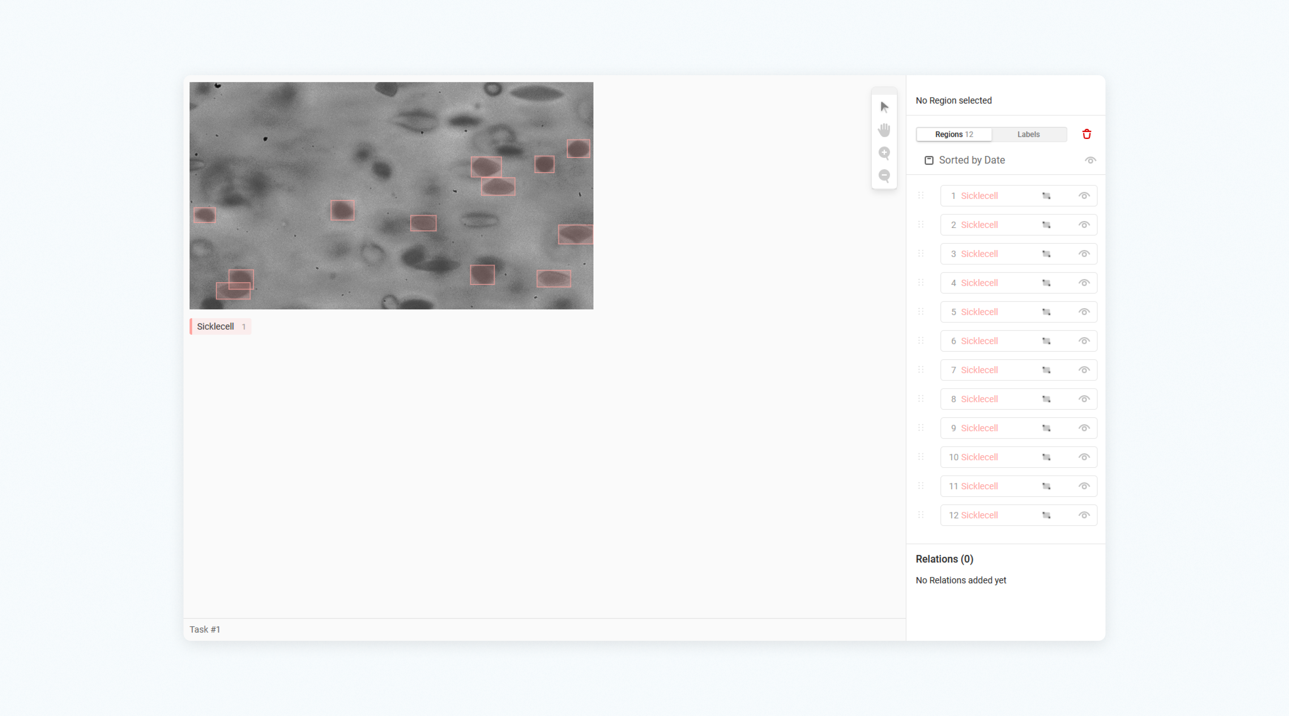 Detecting sickle cells using AI
