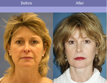 Alexis Shapiro Then And Now