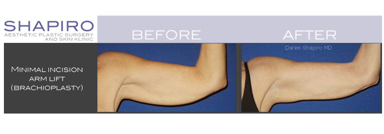 Toned Arms Are Possible With A Minimal Incision Arm Lift - Dr. Shapiro ...