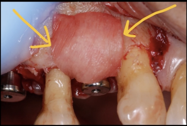 OsseoSeal Resorbable Porcine Collagen Membrane OsseoSeal Resorbable Porcine Collagen Membrane