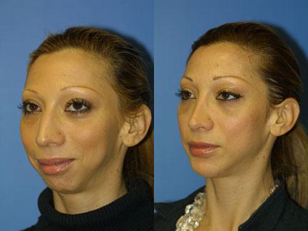 Define Your Chin, Enhance Your Look - Philip Miller MD