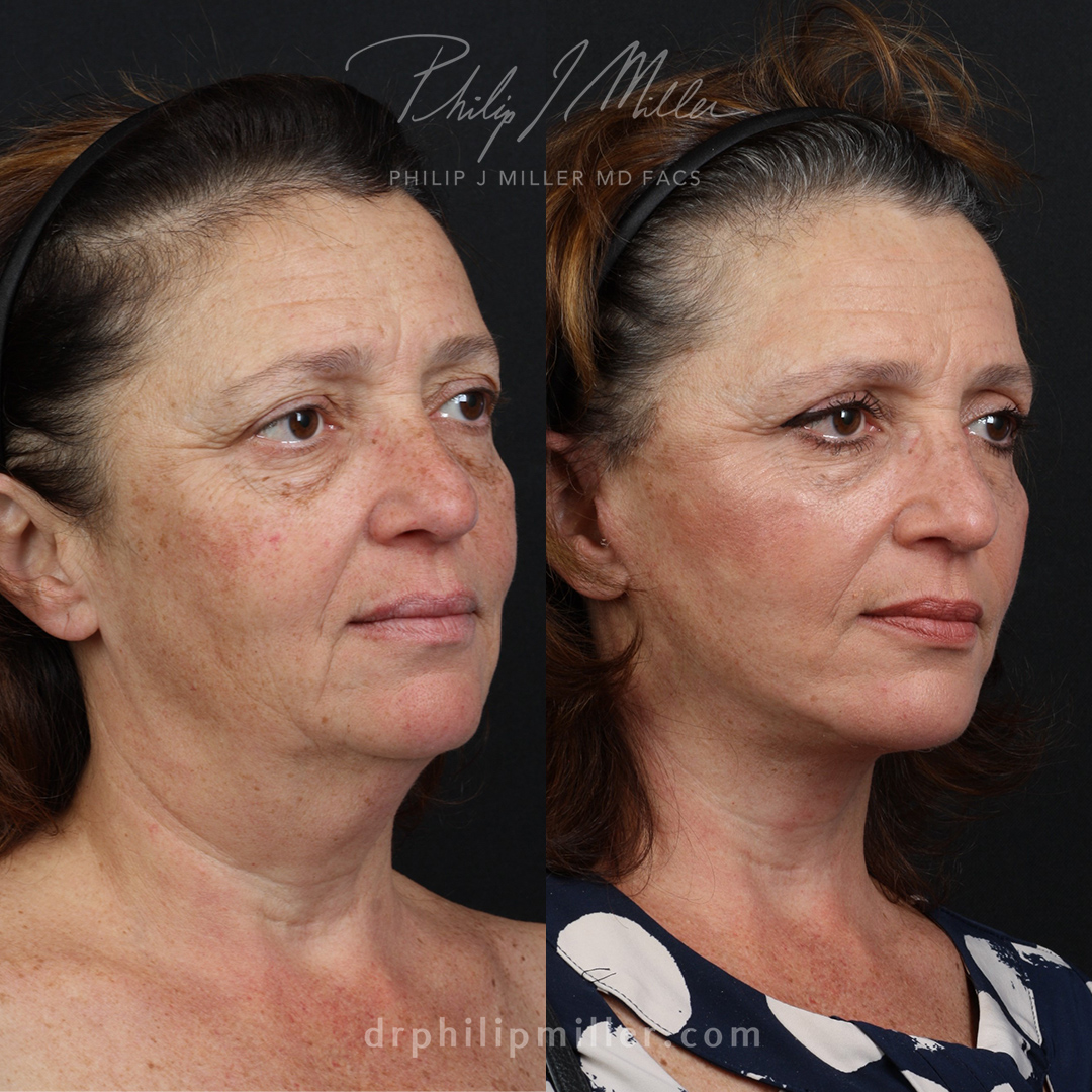 Mini Facelift in New Orleans | Mini Rhytidectomy in New Orleans, LA